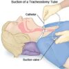 Perform Tracheostomy Care - Nurses Revision