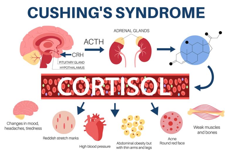 Cushing’s Syndrome - Nurses Revision