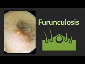 Furunculosis - Nurses Revision
