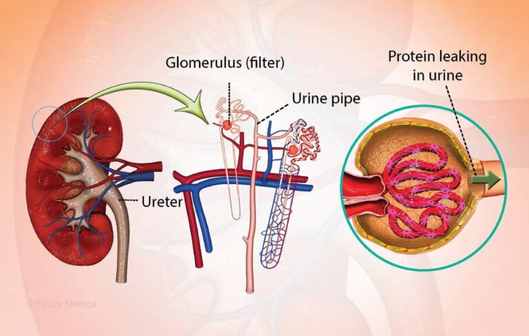 Nephrotic and Nephritic syndromes - Nurses Revision