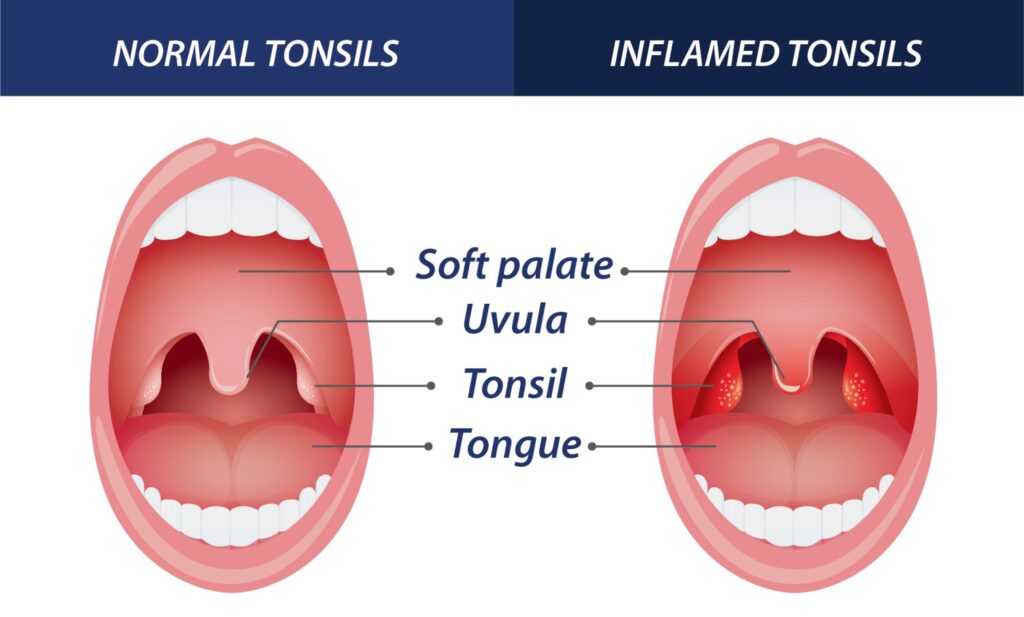 Tonsillitis Nurses Revision