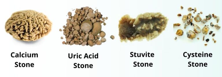 Kidney Stones / Renal Calculi - Nurses Revision
