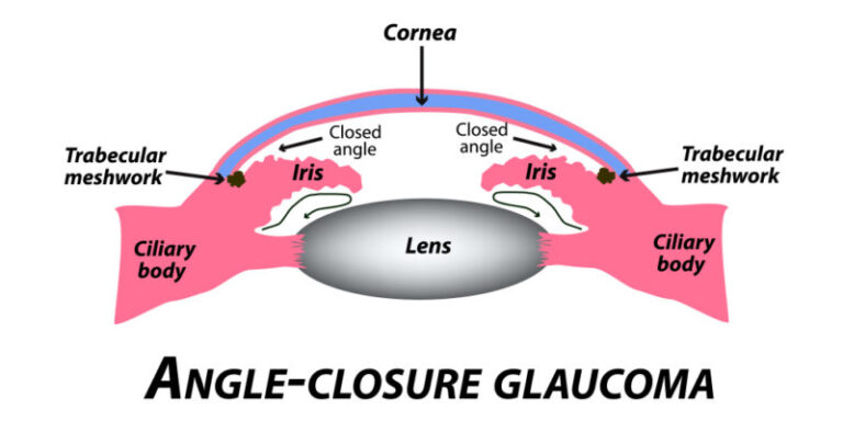Glaucoma - Nurses Revision