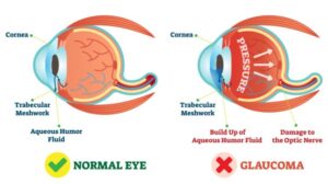 Glaucoma - Nurses Revision