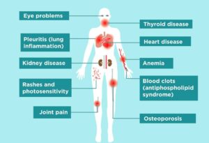Systemic Lupus Erythematosus (SLE) - Nurses Revision