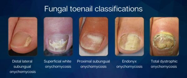 Onychomycosis - Nurses Revision