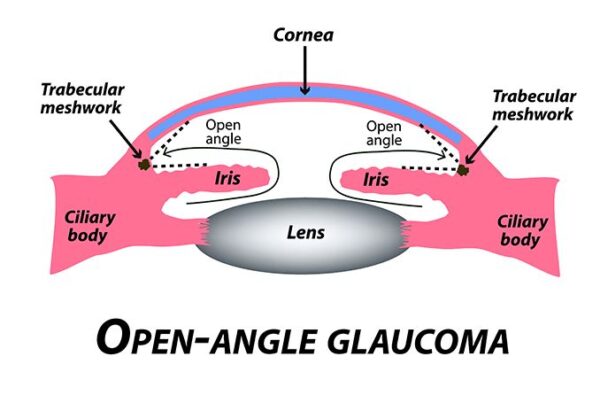 Glaucoma - Nurses Revision