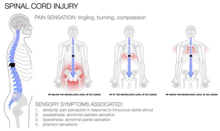 Spinal Cord Compression - Nurses Revision
