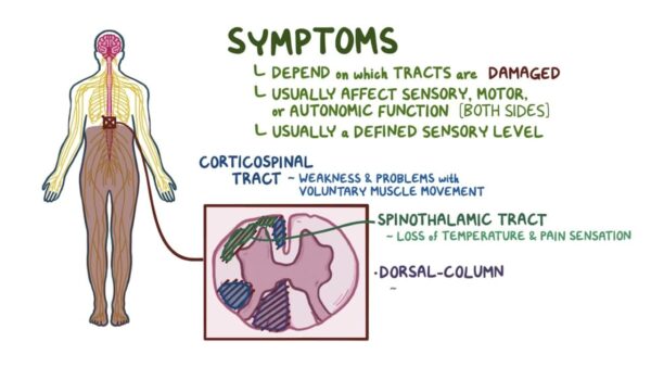 Transverse Myelitis - Nurses Revision