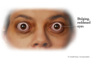 Proptosis / Exophthalmos - Nurses Revision
