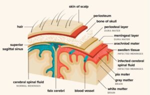 MENINGITIS - Nurses Revision