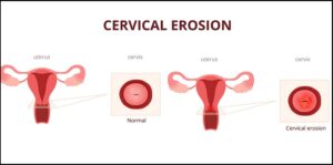 CERVICAL ECTROPION (CERVICAL EROSION) - Nurses Revision