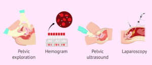 Pelvic Inflammatory Diseases (PID) - Nurses Revision