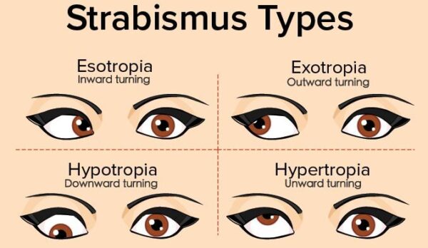 STRABISMUS - Nurses Revision