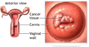 Cancers of Reproductive Health Organs - Nurses Revision