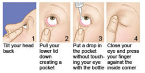 CARE OF THE PATIENT’S EYES - Nurses Revision