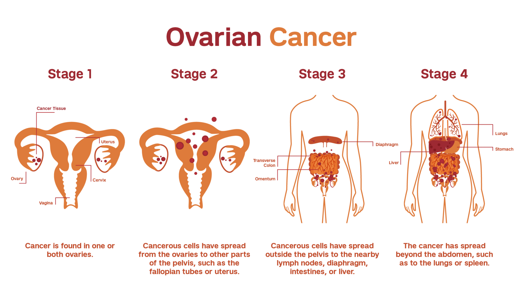 Cancers of Reproductive Health Organs - Nurses Revision