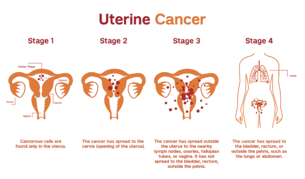 Cancers of Reproductive Health Organs - Nurses Revision