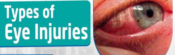 Eye Injuries in Children - Nurses Revision