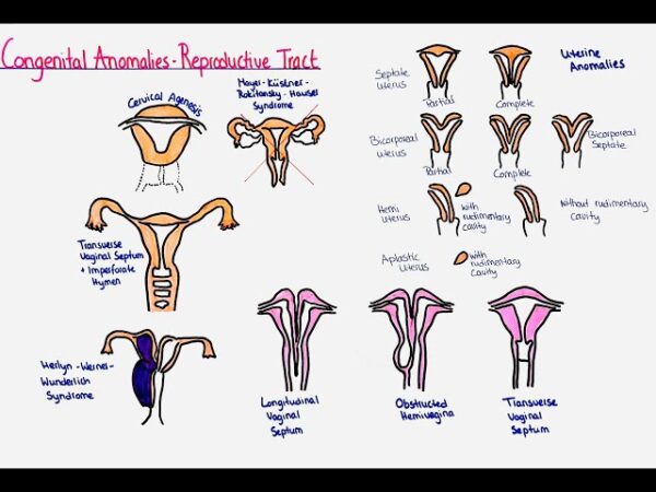 Congenital Abnormalities of the Reproductive Organs - Nurses Revision