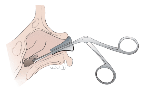Removal of foreign bodies from the ear and nose - Nurses Revision