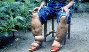 Elephantiasis (Bancroftian Filariasis) - Nurses Revision