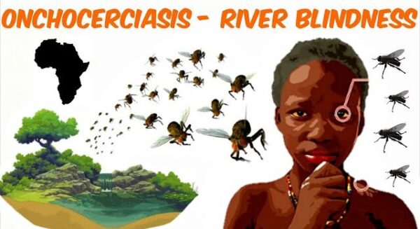 Onchocerciasis (River blindness) - Nurses Revision