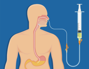 Naso-Gastric Tube and Tube Feeding - Nurses Revision