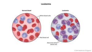 LEUKEMIA - Nurses Revision